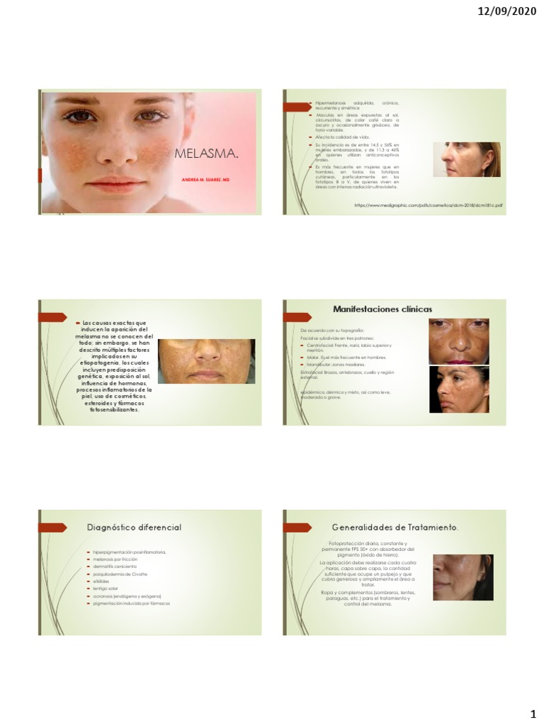 Melasma Diapositivas | PDF | Medicamentos con receta | Medicina CLINICA