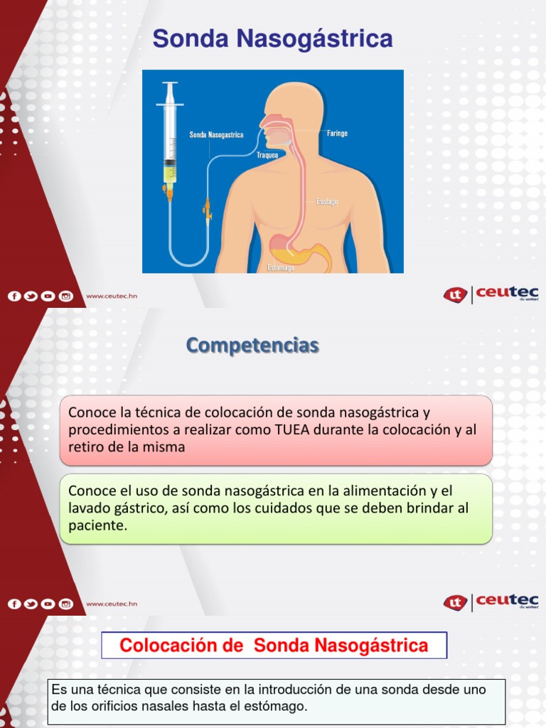 Técnica de Colocación de Sonda Nasogástrica | PDF | Medicina ...