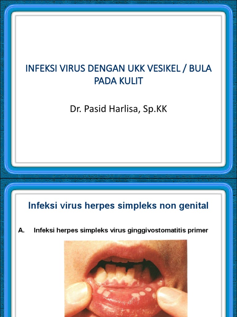 Infeksi Virus: Herpes dan Varicella | PDF