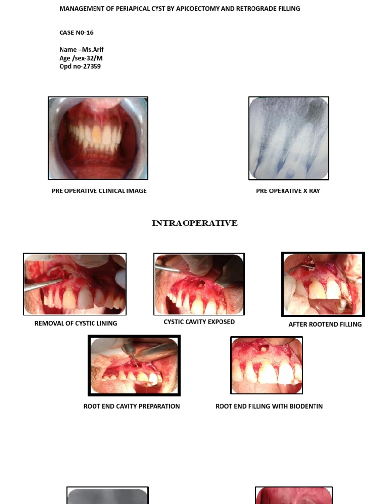 Special Case 2-MANAGEMENT OF PERIAPICAL CYST BY APICOECTOMY AND ...