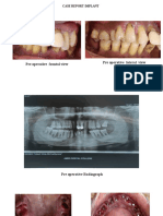 Residual Ridge Resorption | PDF | Bone | Dentures