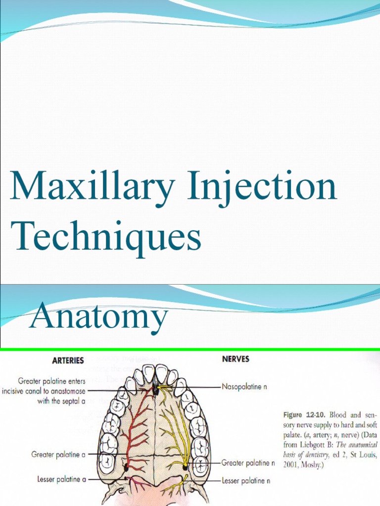 Maxillary Injection Techniques | PDF | Anesthesia | Injection (Medicine)