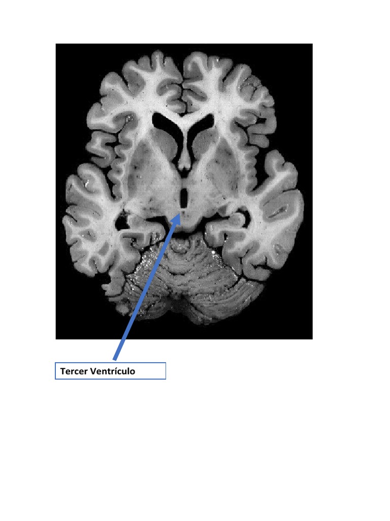 Tercer Ventrículo | PDF