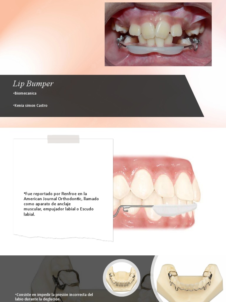 Lip Bumper, Quad Helix | PDF | Diente | Anatomia dental