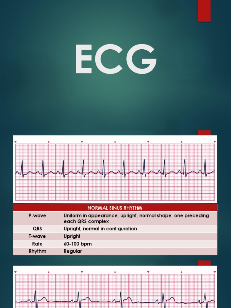 Ecg Handout | PDF | Cardiovascular Physiology | Cardiovascular Diseases