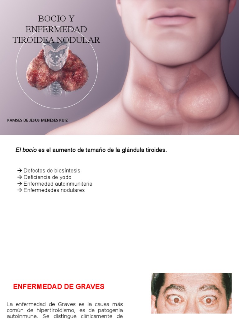 Bocio Nodulos Endocrinologia | PDF | Tiroides | Hipertiroidismo