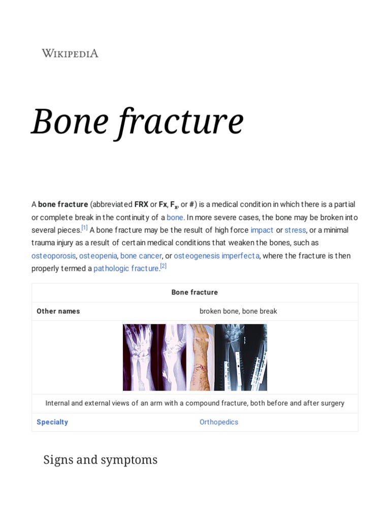 Bone Fracture | PDF | Human Anatomy | Skeletal System
