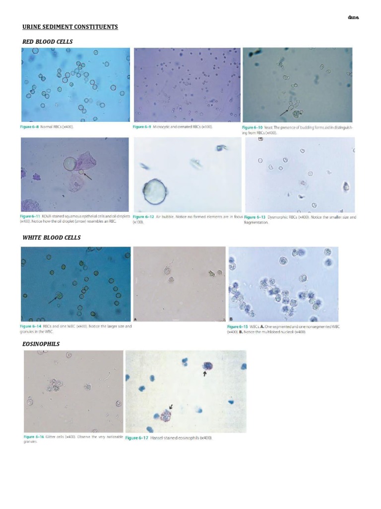 Urine sediment constituents and cells guide | PDF