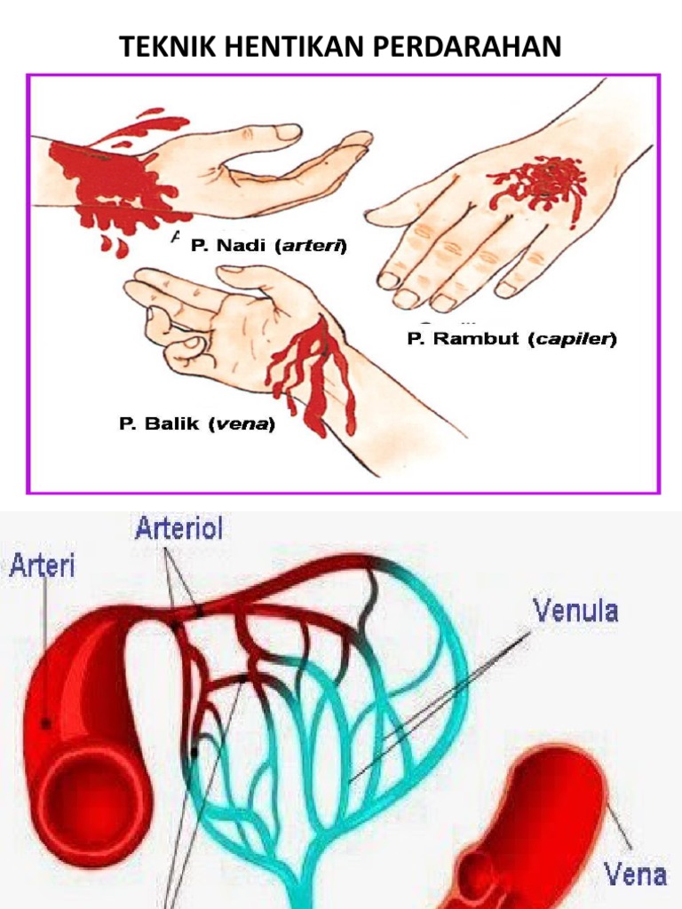 2 Teknik Hentikan Perdarahan | PDF