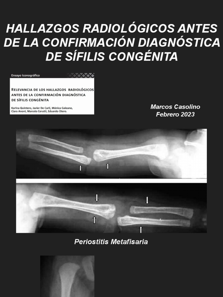 Hallazgos Radiológicos Sífilis Congénita | PDF