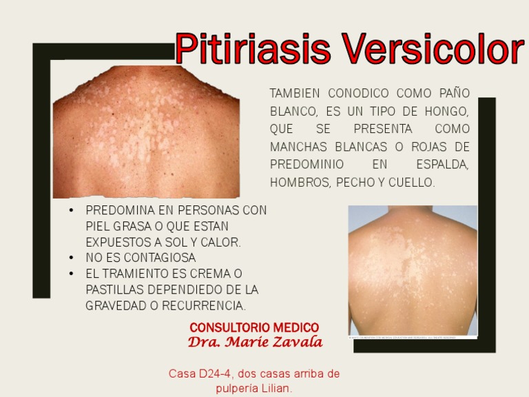 Pitiriasis Versicolor | PDF