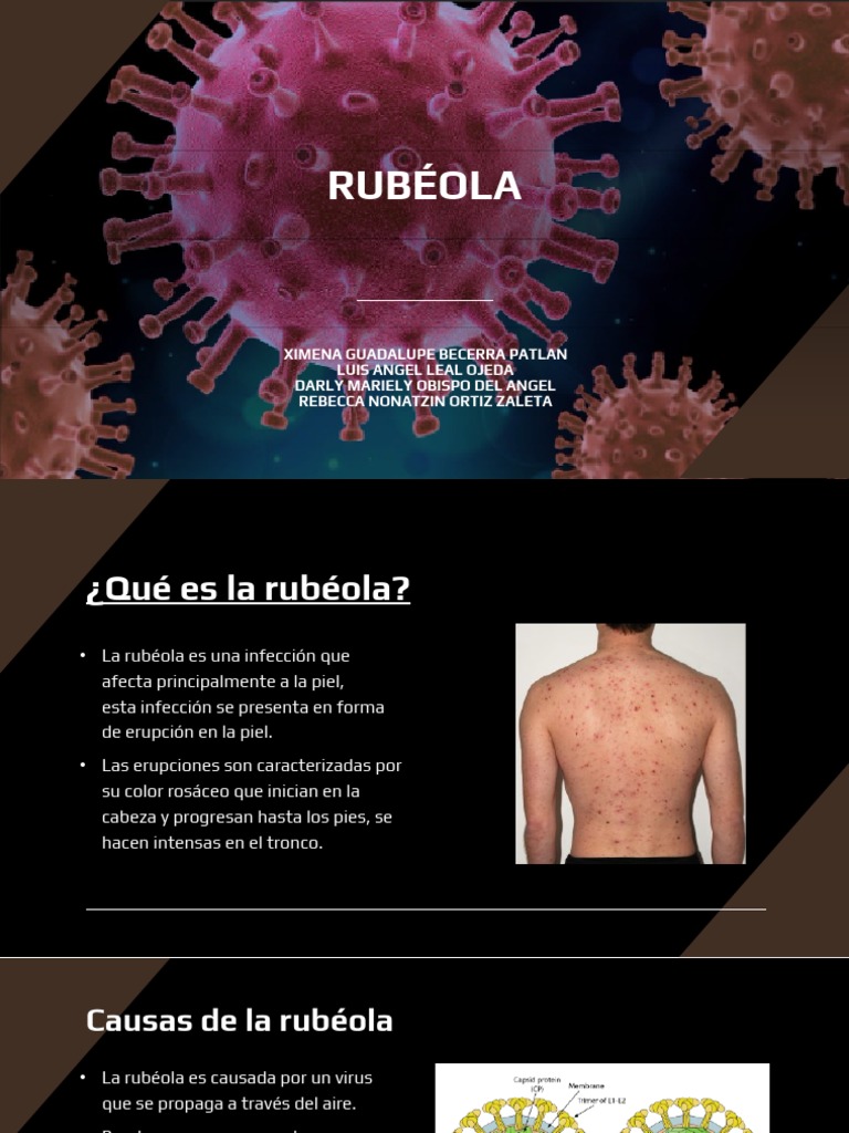 Rubéola | PDF
