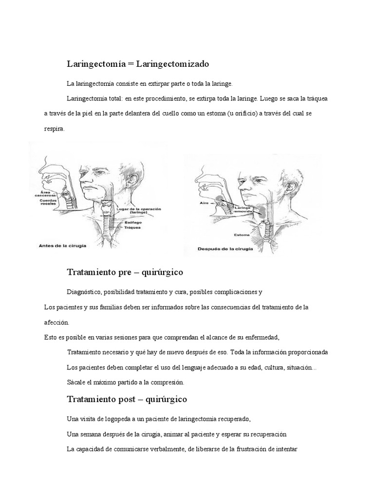 Laringectomía | PDF | Causas de la muerte | Medicina