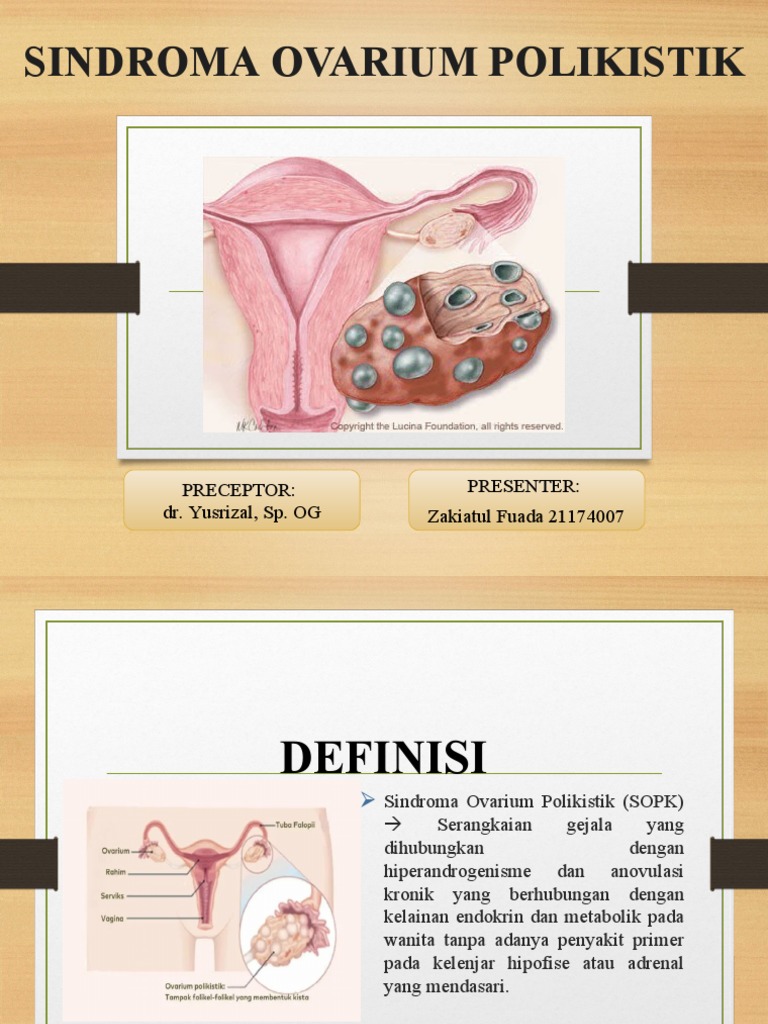 1 Referat Sindrom Ovarium Polikistik | PDF