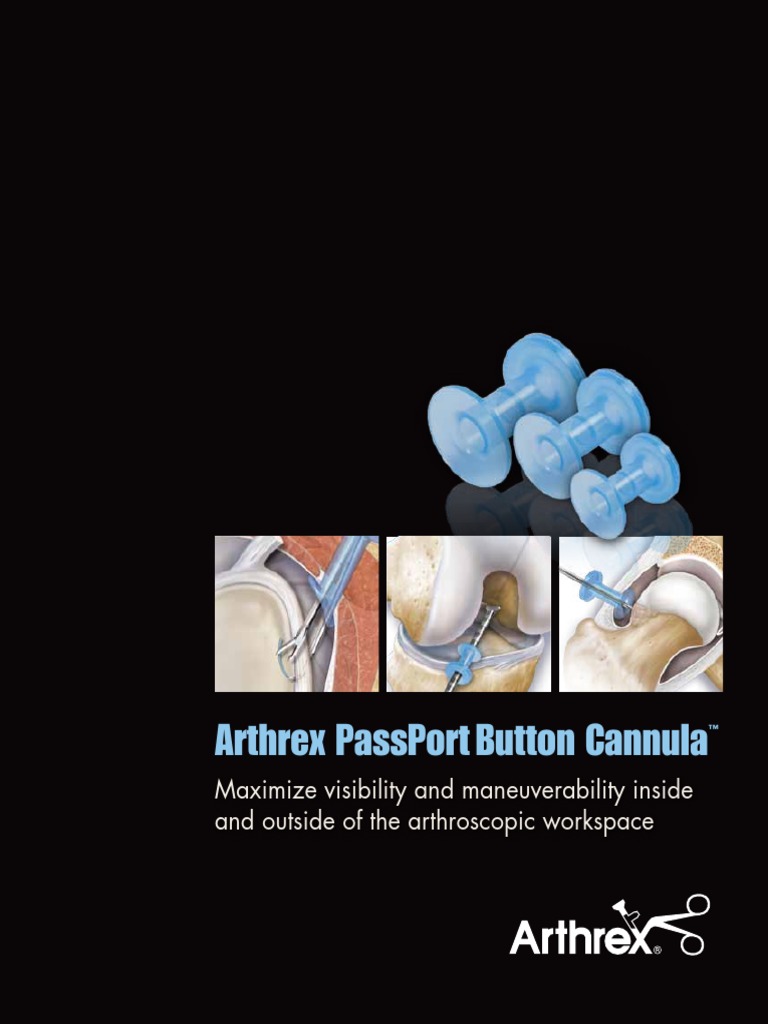 Arthrex Passport Button Cannula: Maximize Visibility and ...