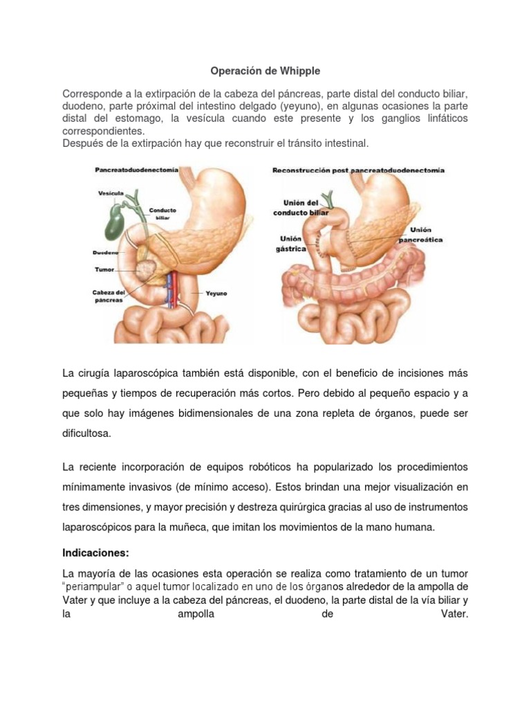Operación de Whipple | PDF