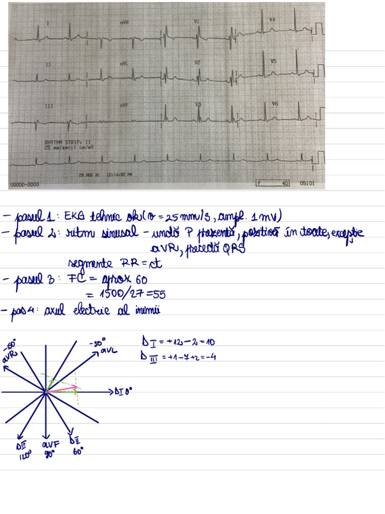 An Analysis of an Electrocardiogram Tracing: Identifying Heart Rhythm ...