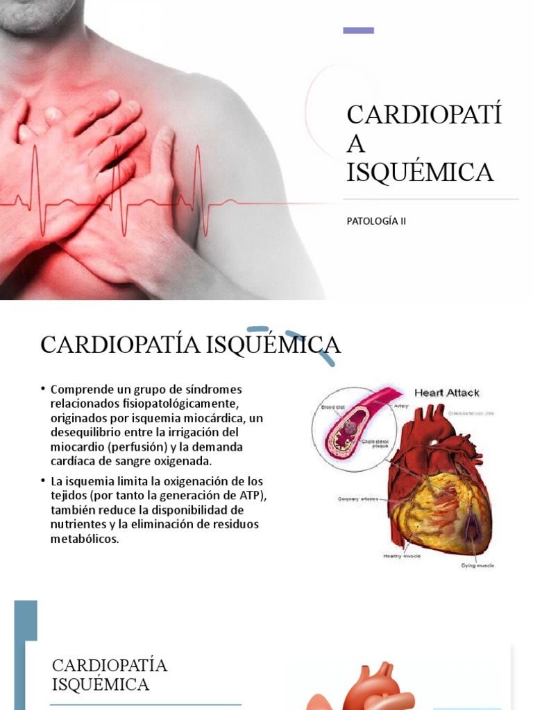 Cardiopatía Isquemica 20 | PDF | Isquemia | Infarto de miocardio