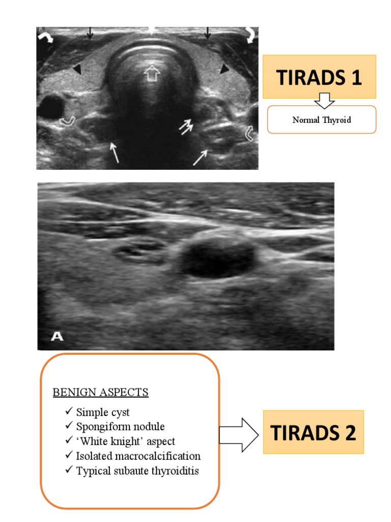 TIRADS | PDF
