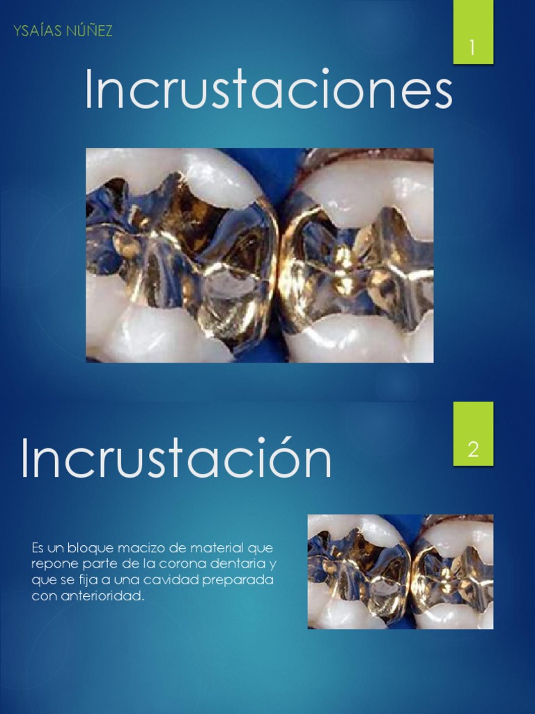 Incrustaciones Metalicas YSAIASN | PDF