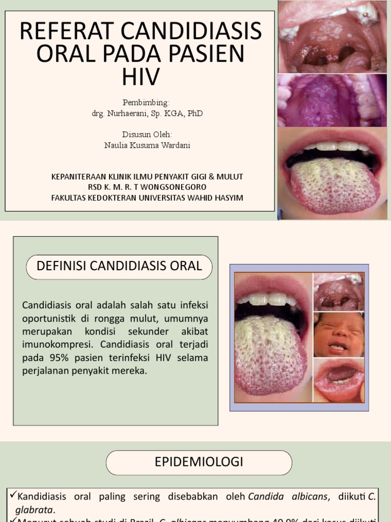Candidiasis Oral Naulia | PDF