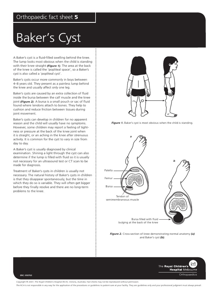 Bakers Cyst | PDF | Knee | Diseases And Disorders