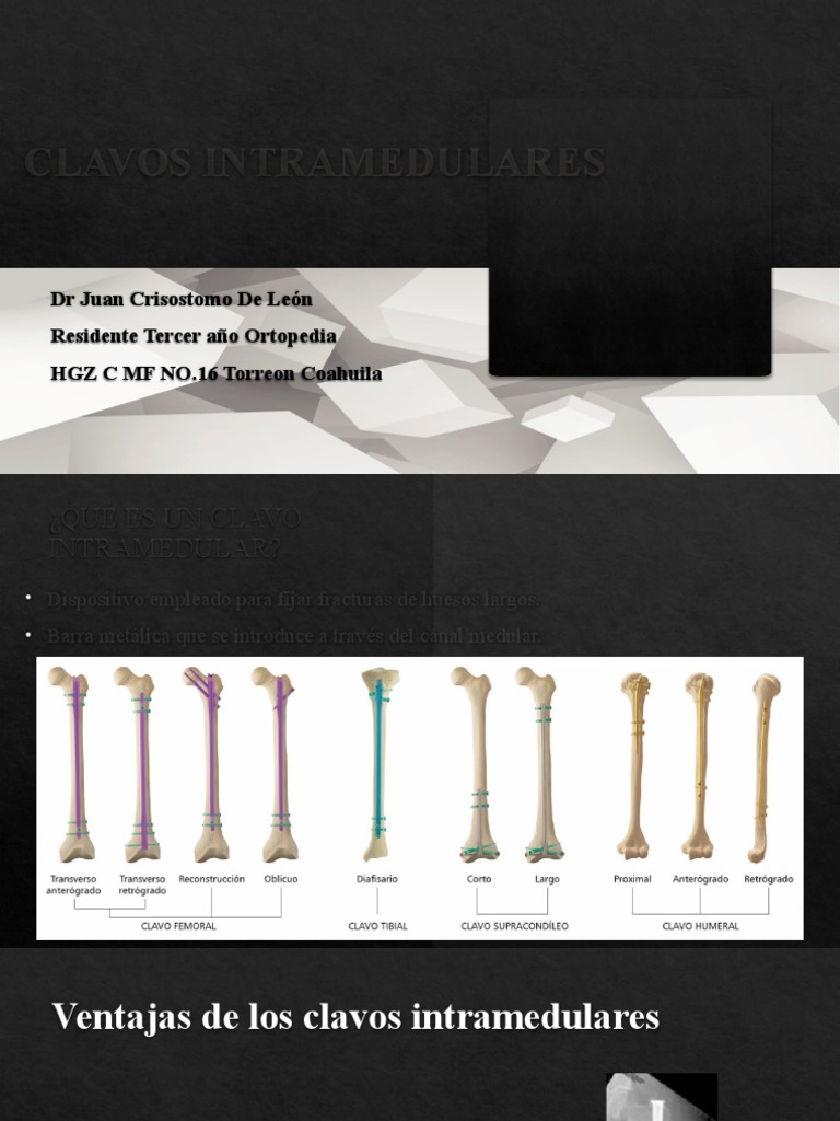 Clavos Intramedulares | PDF