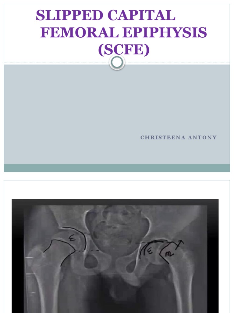 Understanding Slipped Capital Femoral Epiphysis | PDF | Clinical ...