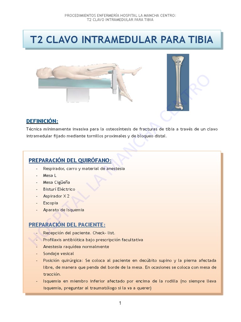 Técnica Quirúrgica Clavo T2 Tibia | PDF | Tornillo | Rodilla