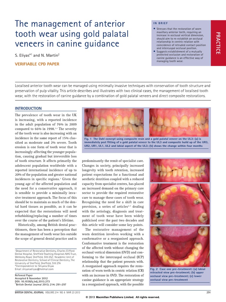 Palatal Veneers | PDF | Dentistry Branches | Dental Anatomy
