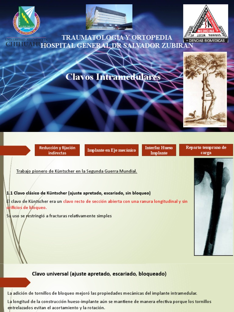 Implantes intramedulares: Fundamentos del enclavado intramedular con ...
