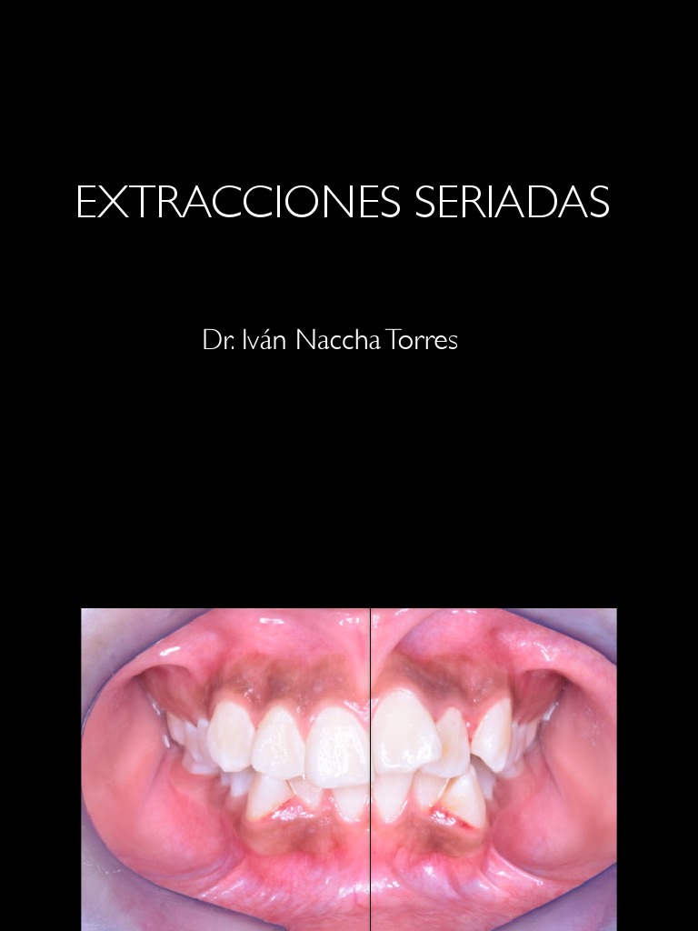 Extracciones Seriadas | PDF | Odontología | Anatomia animal