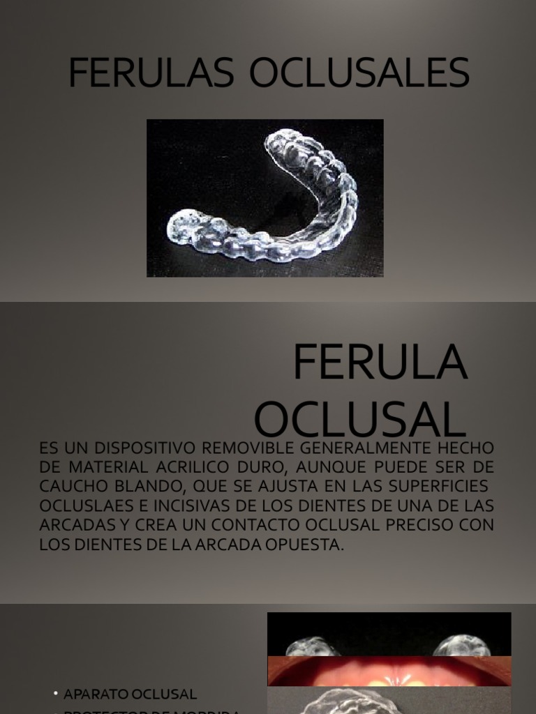 Ferulas Oclusales | PDF | Ortodoncia