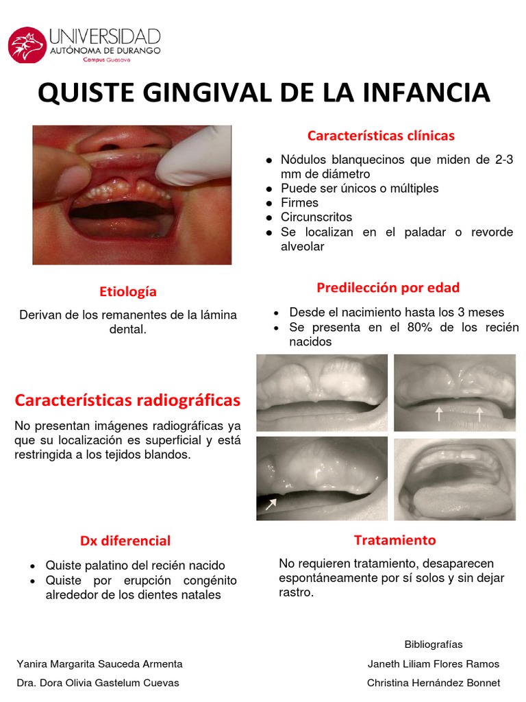 Quiste Gingival | PDF