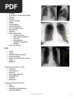 Bullas y Cavernas en Lesiones Pulmonares | PDF | Pulmón | Ct Scan