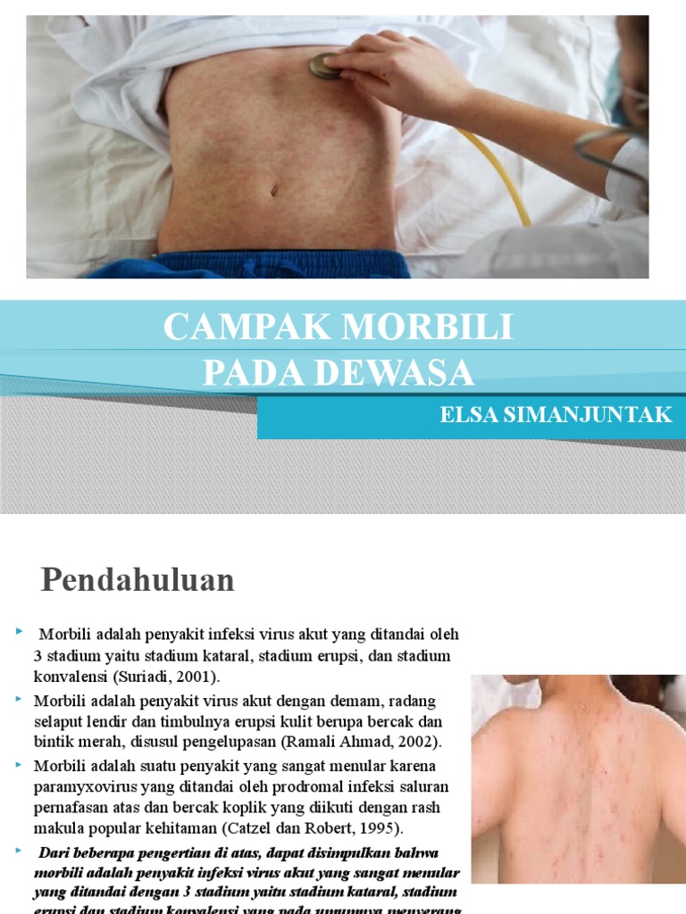Campak Morbili Pada Dewasa | PDF