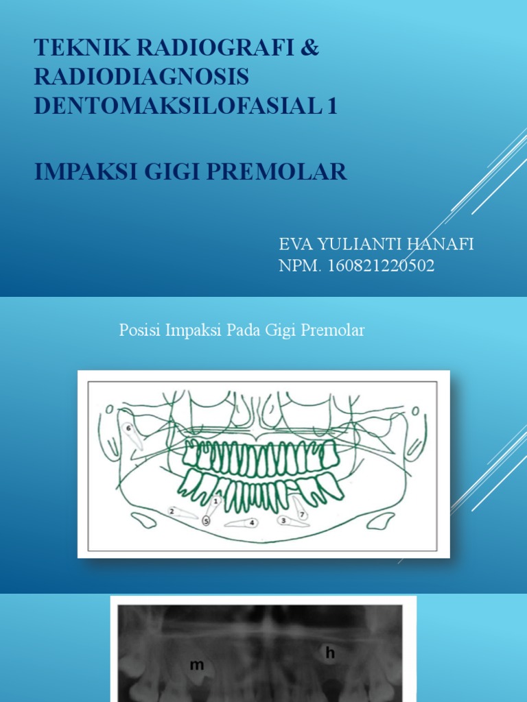 Kasus 4 - Tutor 9 - Dok Farina - Impaksi Gigi Premolar | PDF