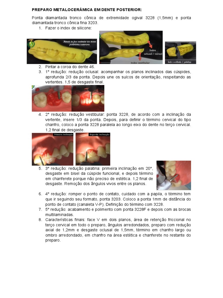 Preparo Metalocerâmica em Dente Posterior | PDF | Casa e Jardim ...