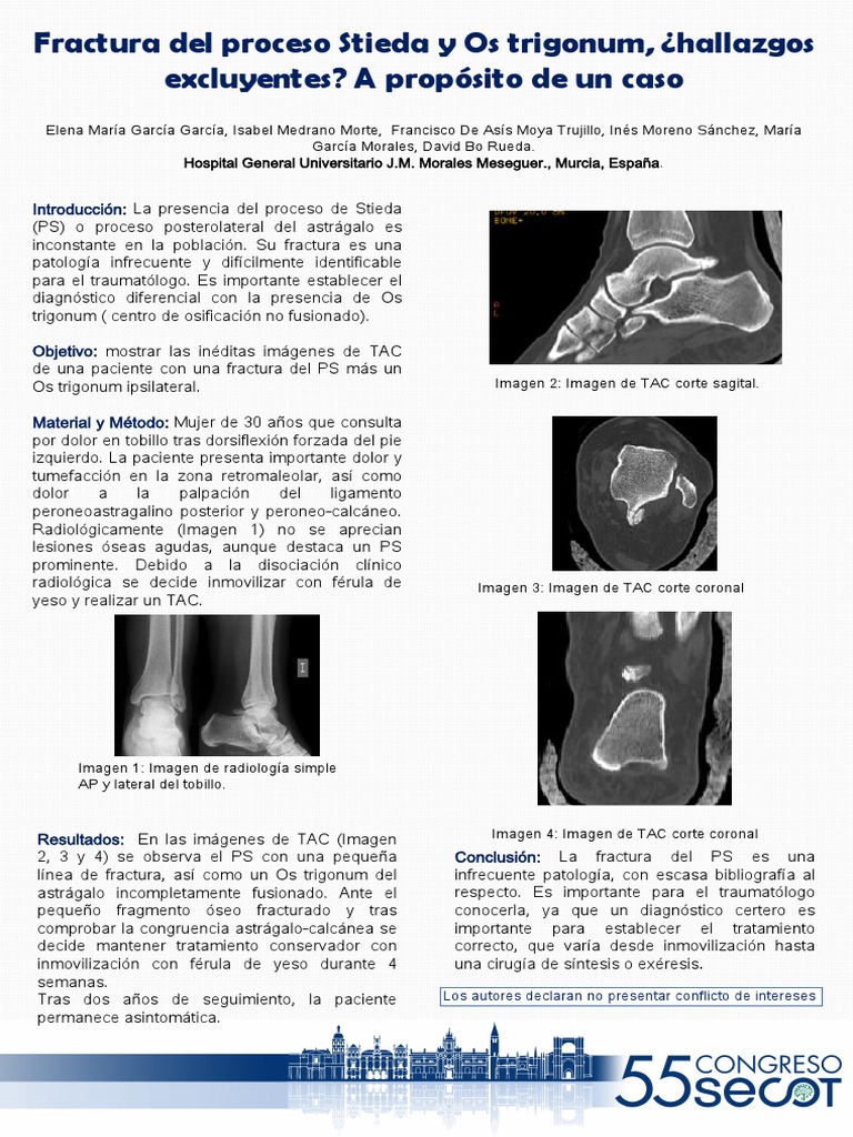 Introducción: Fractura Del Proceso Stieda y Os Trigonum, ¿Hallazgos ...