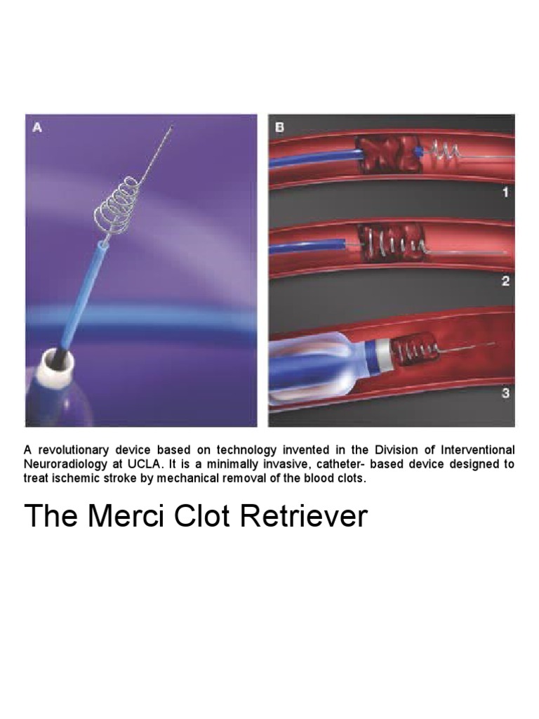Merci Retriever | PDF | Stroke | Medicine