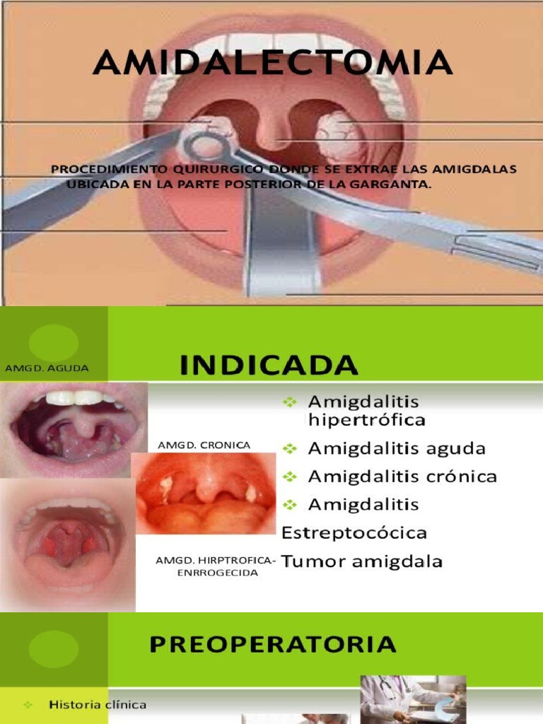 Cuidados Postoperatorios en Amigdalectomía | PDF