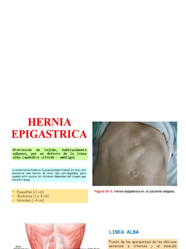 Hernia Epigastrica | PDF | Abdomen | Causas de la muerte