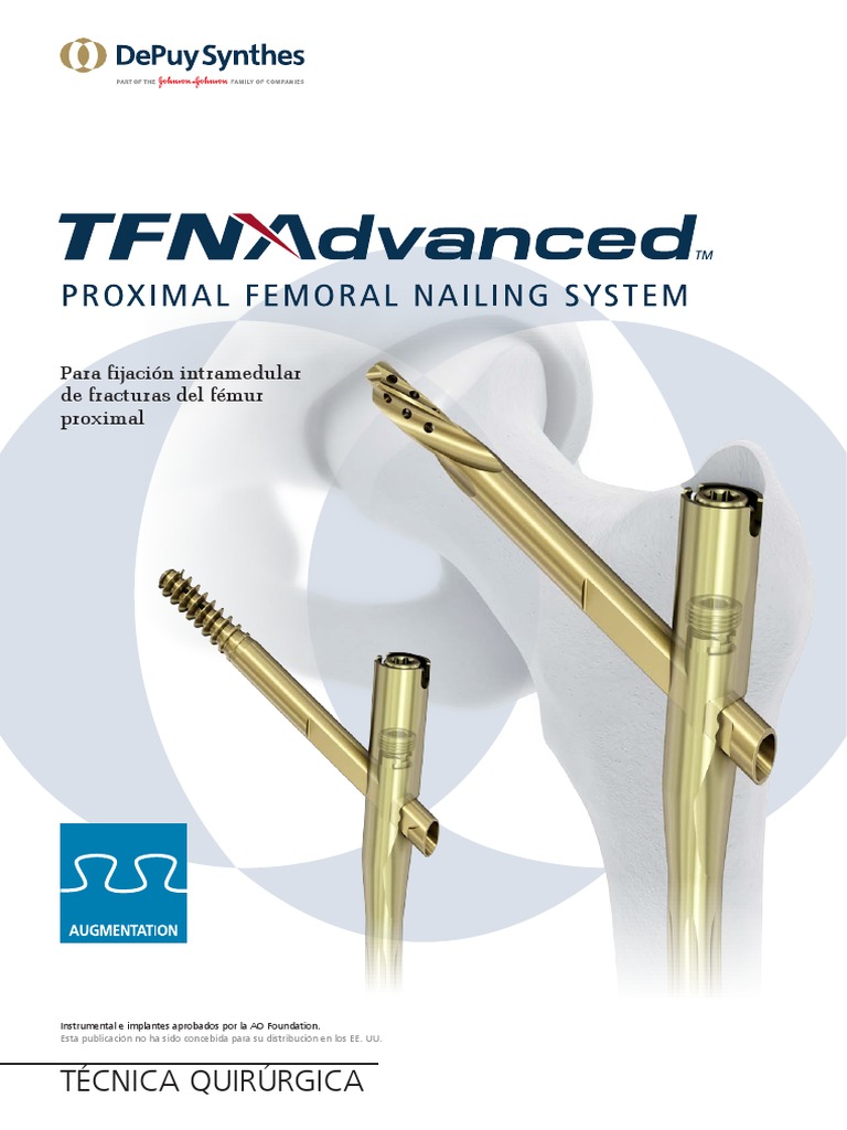 Tfna Tecnica Quirurgica PDF | PDF | Tornillo | Perforación