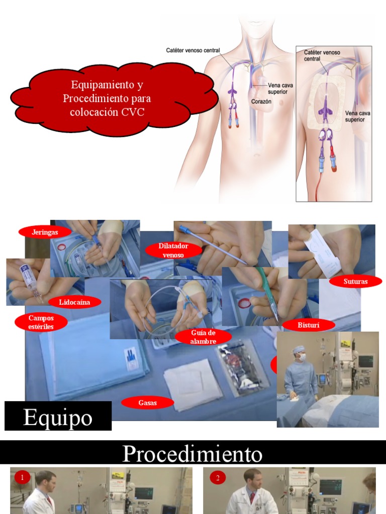 Equipamiento y Procedimiento para colocación CVC | PDF