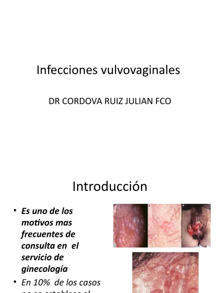 Infecciones Vulvovaginales Semi 22 | PDF | Salud pública | Reproducción humana