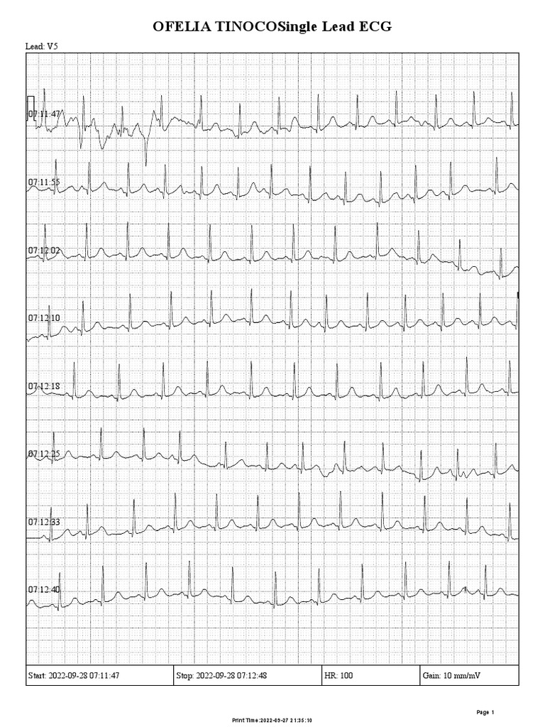 Holter | PDF