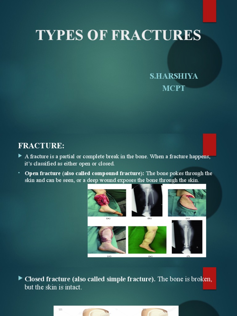 Types of Fractures | PDF | Medical Imaging | Bone