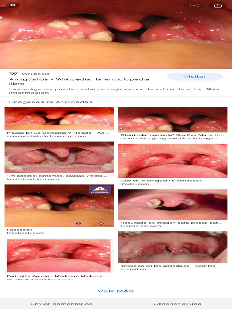 Amigdalitis - Búsqueda de Google | PDF | Ciencia y matemáticas