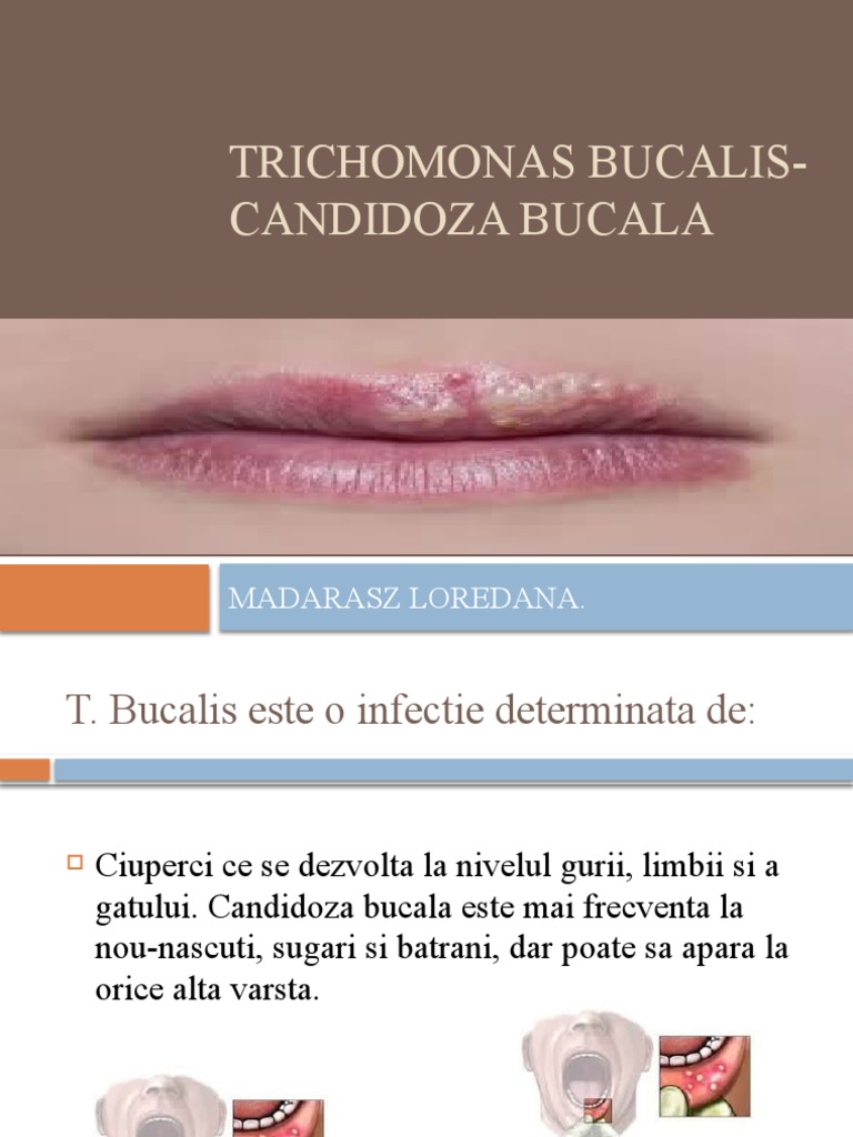 Trichomonas Bucalis - Candidoza Bucala | PDF