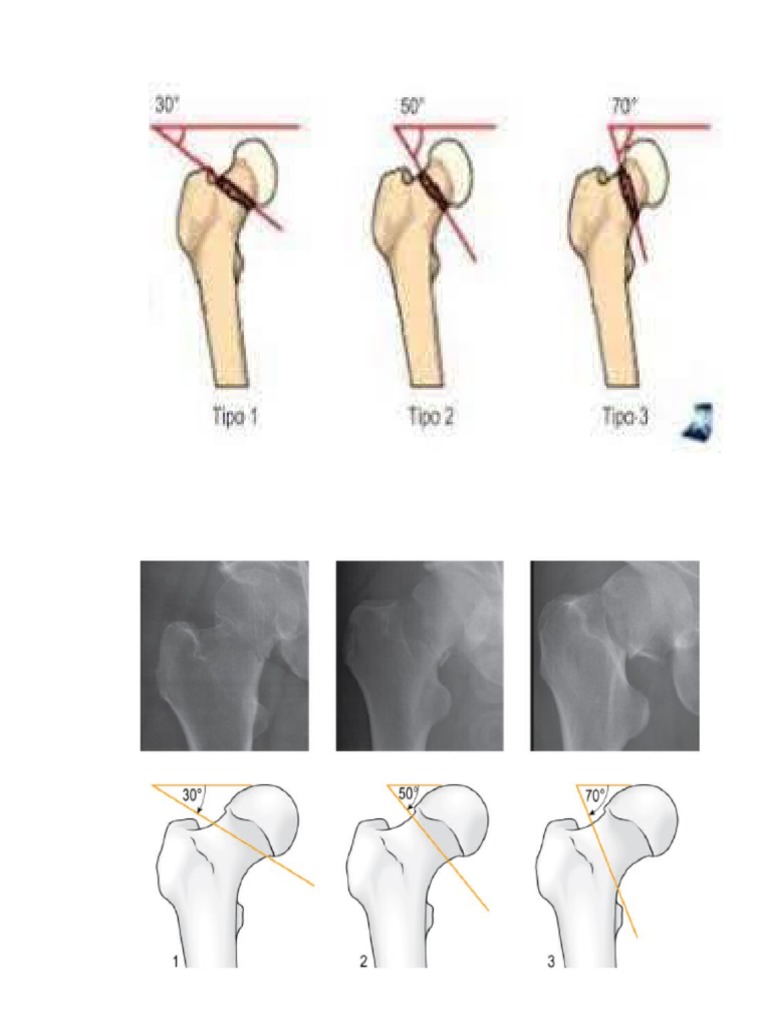 clasificacion de pauwels | PDF